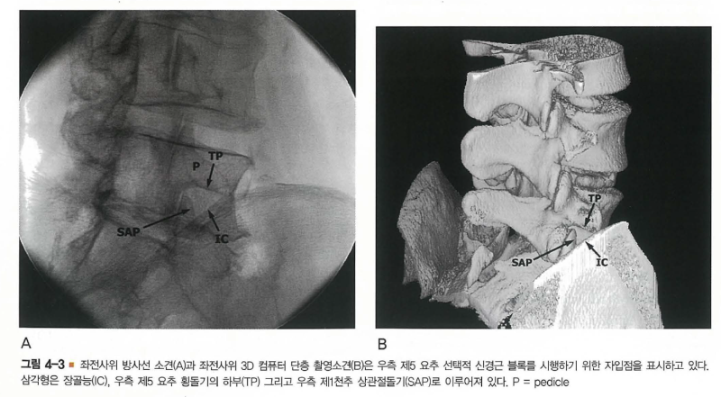 [외래/주사/척추]L-SNRB Selective Nerve Root Block /transforaminal block ...