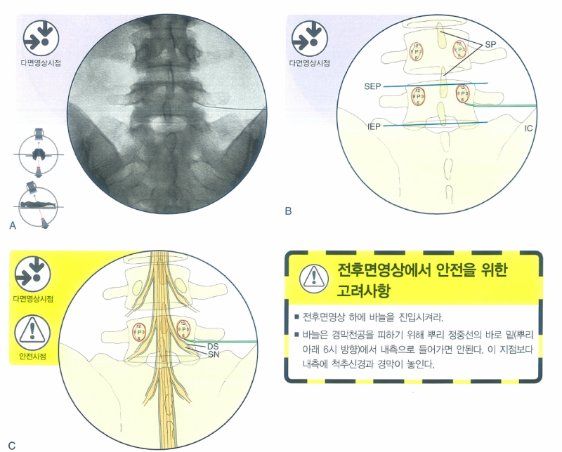 [외래/주사/척추]L-SNRB Selective Nerve Root Block /transforaminal block ...