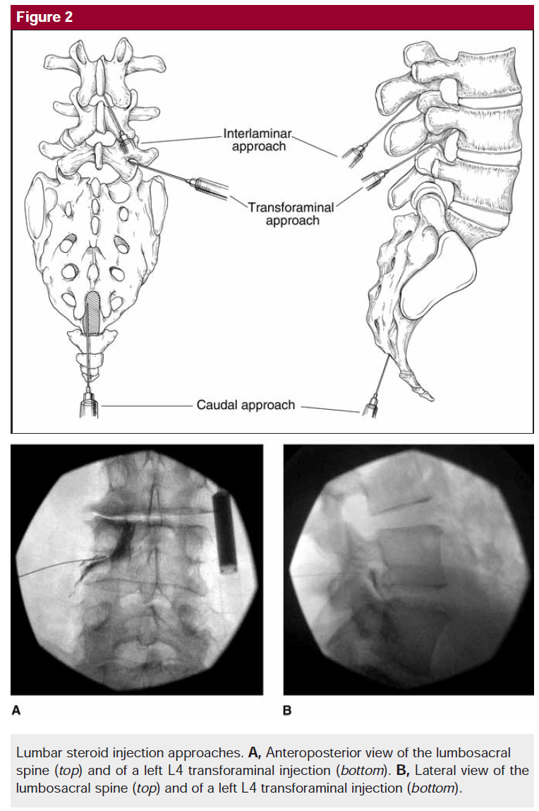 [외래/주사/척추]L-SNRB Selective Nerve Root Block /transforaminal block ...