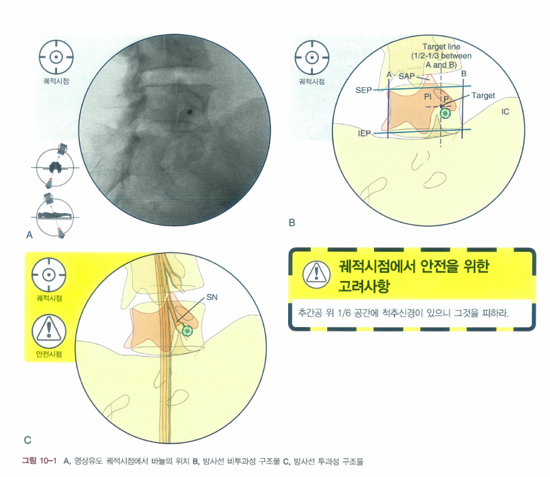 [외래/주사/척추]L-SNRB Selective Nerve Root Block /transforaminal block ...