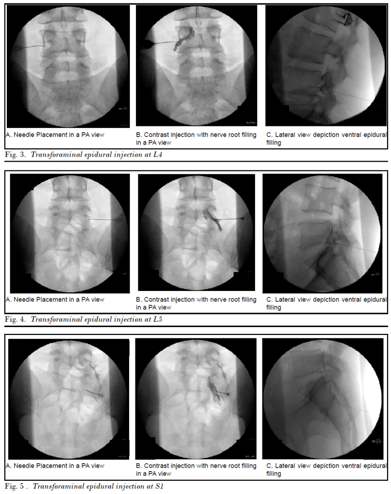 [외래/주사/척추]L-SNRB Selective Nerve Root Block /transforaminal block ...