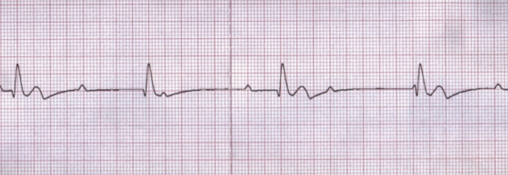 PEA 와 Asystole rhythm 그리고 사망 간호 : 네이버 블로그