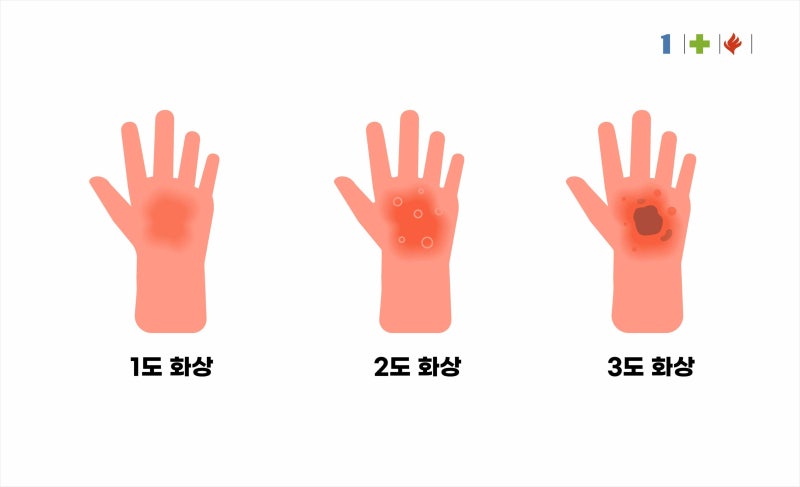 화상 물집 손가락 화상 물집 생겼을때 응급처치 및 대처 방법 네이버 블로그