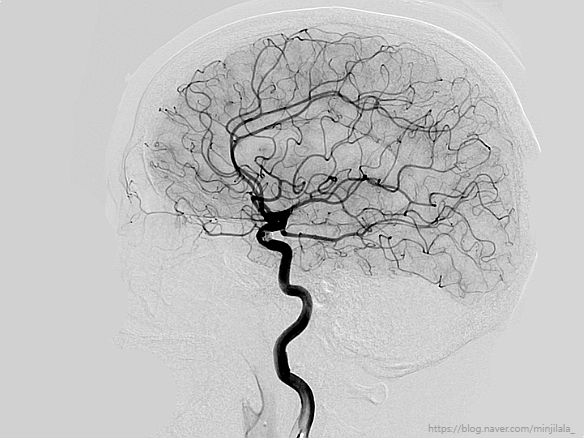 뇌혈관조영술 TFCA DSA 4vessel angiography 검사목적 적응증 검사방법 치료 부작용 주의사항 : 네이버 블로그