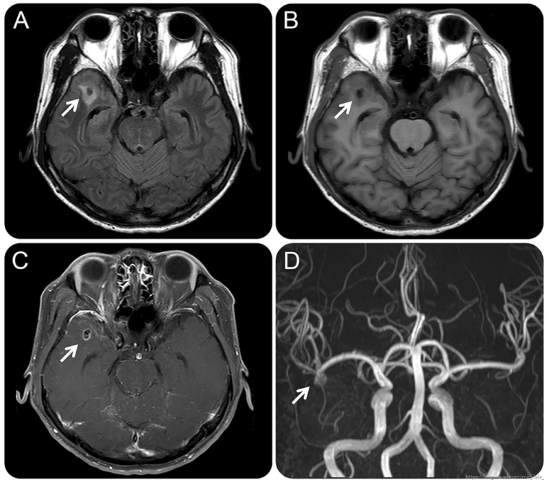 뇌동맥류 뇌동맥꽈리 cerebral aneurysm 종류 치료법 rupture (+coil embolization ...
