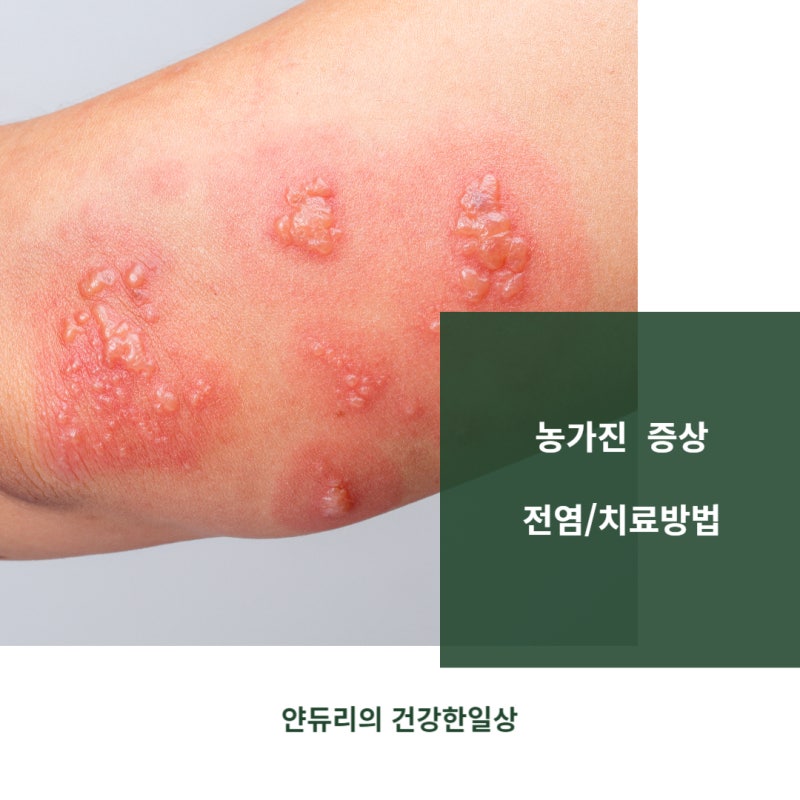 농가진 이란 증상전염치료방법 정리해봤어요 네이버 블로그