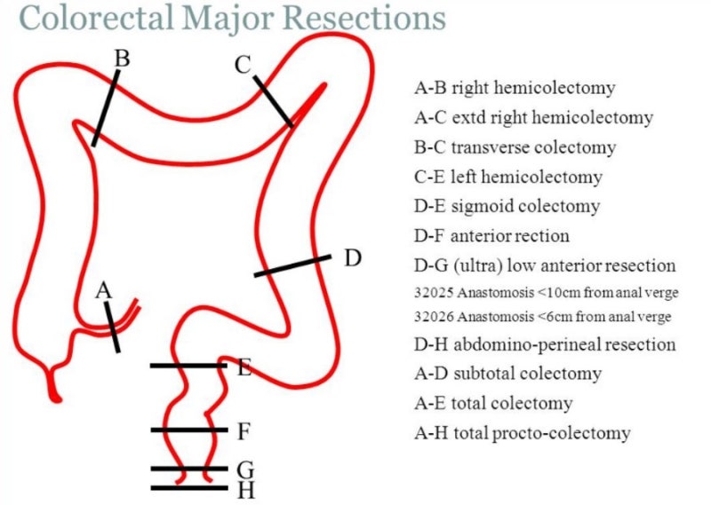GS-colon) 복강경 저위 절제술 laparoscopic AR/LAR : 네이버 블로그