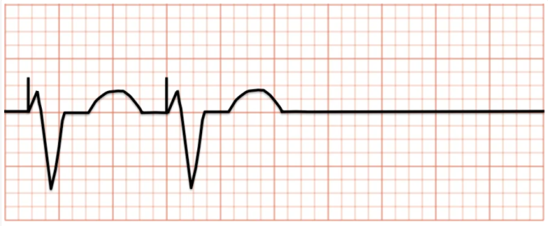 경피심장박동조율 (Transcutaneous pacing, TCP) : 네이버 블로그