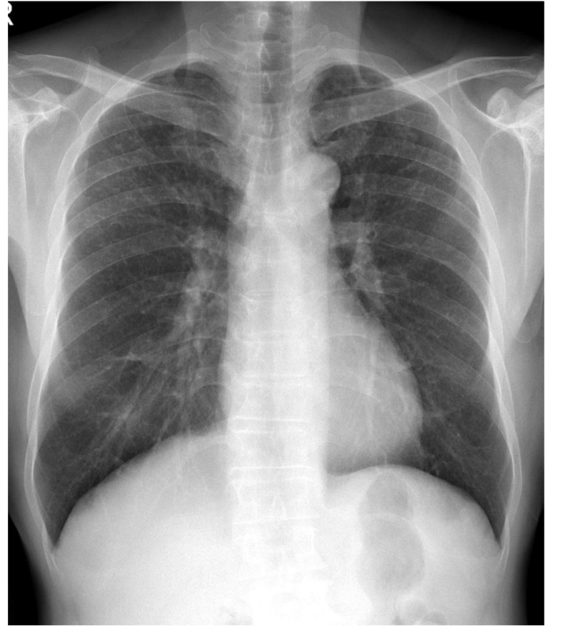 비활동성 폐결핵 증례 흉부x선 사진 Tuberculoma Subpleural Bullae 폐기종 Micronodule