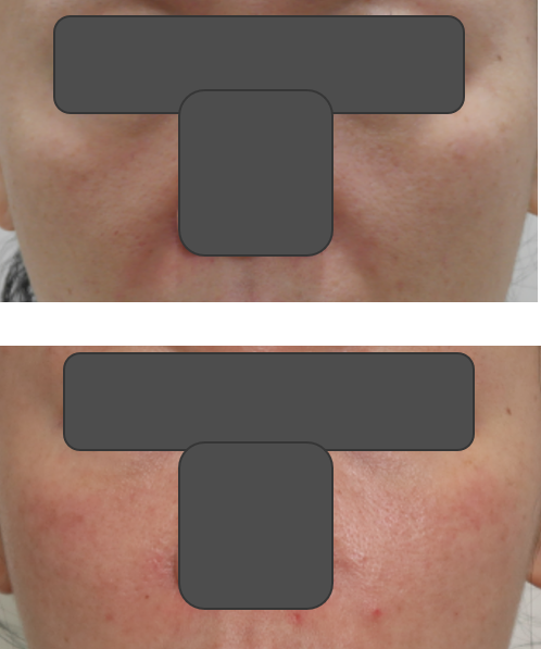 콜라겐 필러 부작용: 오해와 진실 및 선택 가이드 : 네이버 블로그