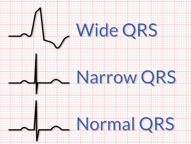 tachycardia, 빈맥 : 네이버 블로그