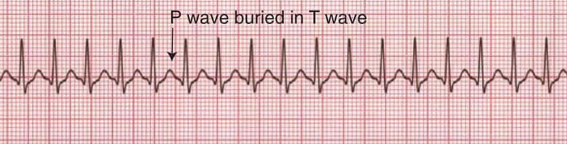 tachycardia, 빈맥 : 네이버 블로그