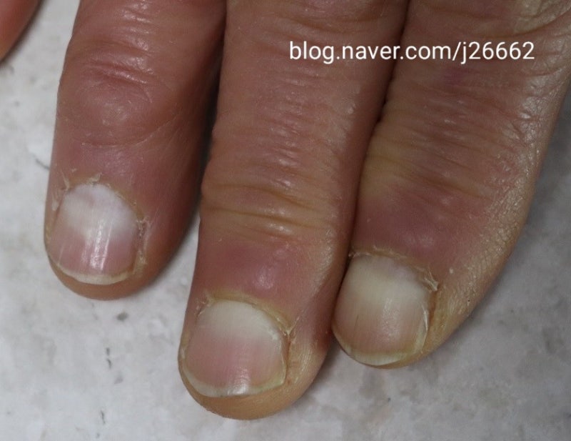 11. 반반손발톱(Half-and-half nail) : 네이버 블로그