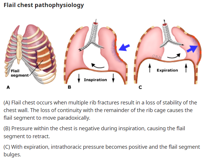 Flail chest (동요 가슴) 정의, 임상특징, 치료 : 네이버 블로그