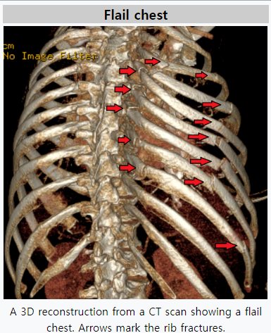 Flail chest (동요 가슴) 정의, 임상특징, 치료 : 네이버 블로그