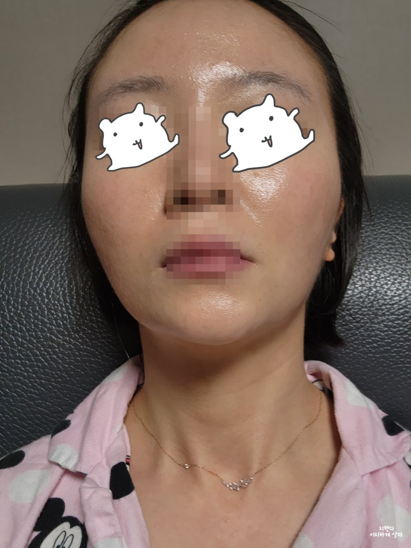 안산 인모드 Fx포마 풀페이스한 후기 심한멍 멍약 1주일 경과 네이버 블로그