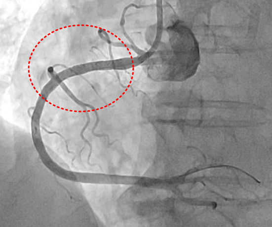 심혈관치료중재시술(PCI) 치료에서 퇴원까지_심장혈관스텐트치료,심장혈관중재술(PTCA, POBA, PCI, PTA) : 네이버 블로그