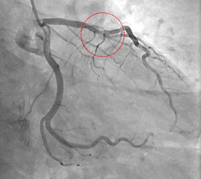 심혈관치료중재시술(PCI) 치료에서 퇴원까지_심장혈관스텐트치료,심장혈관중재술(PTCA, POBA, PCI, PTA) : 네이버 블로그