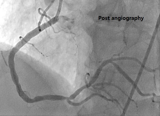심혈관치료중재시술(PCI) 치료에서 퇴원까지_심장혈관스텐트치료,심장혈관중재술(PTCA, POBA, PCI, PTA) : 네이버 블로그