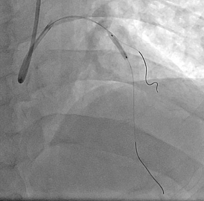 심혈관치료중재시술(PCI) 치료에서 퇴원까지_심장혈관스텐트치료,심장혈관중재술(PTCA, POBA, PCI, PTA) : 네이버 블로그