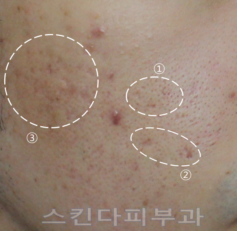 여드름흉터 프락셀쥬베룩서브시전다운타임없는 레이저치료과정2편 네이버 블로그