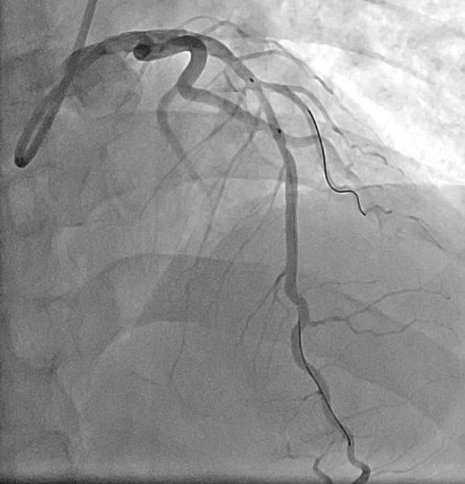 심혈관치료중재시술(PCI) 치료에서 퇴원까지_심장혈관스텐트치료,심장혈관중재술(PTCA, POBA, PCI, PTA) : 네이버 블로그