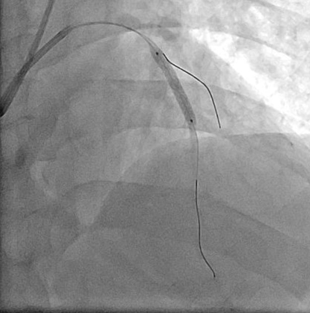 심혈관치료중재시술(PCI) 치료에서 퇴원까지_심장혈관스텐트치료,심장혈관중재술(PTCA, POBA, PCI, PTA) : 네이버 블로그