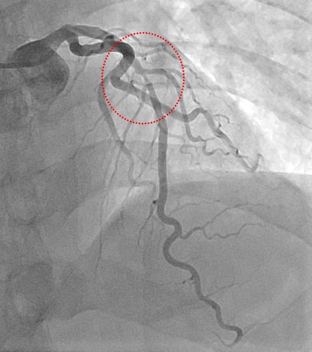 심혈관치료중재시술(PCI) 치료에서 퇴원까지_심장혈관스텐트치료,심장혈관중재술(PTCA, POBA, PCI, PTA) : 네이버 블로그