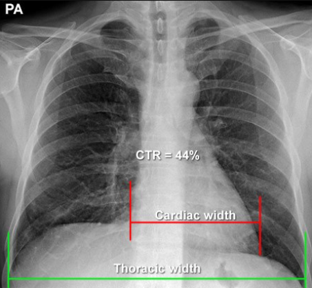 Chest PA, AP 차이에 대해서, chest x-ray는 입원하면 왜 자주 찍을까? : 네이버 블로그
