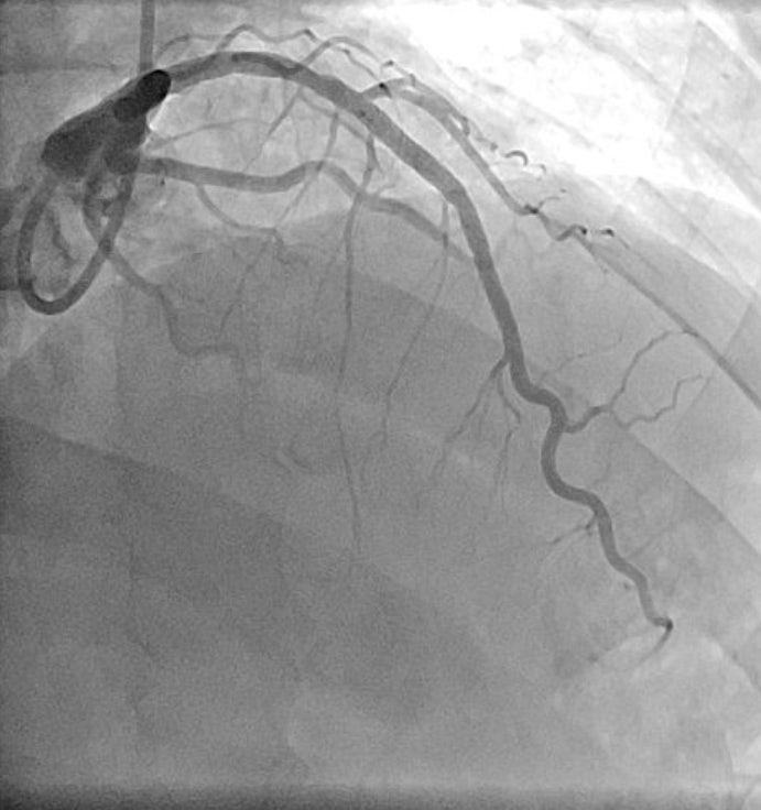 심혈관치료중재시술(PCI) 치료에서 퇴원까지_심장혈관스텐트치료,심장혈관중재술(PTCA, POBA, PCI, PTA) : 네이버 블로그