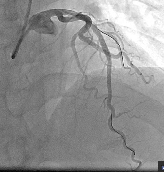 심혈관치료중재시술(PCI) 치료에서 퇴원까지_심장혈관스텐트치료,심장혈관중재술(PTCA, POBA, PCI, PTA) : 네이버 블로그