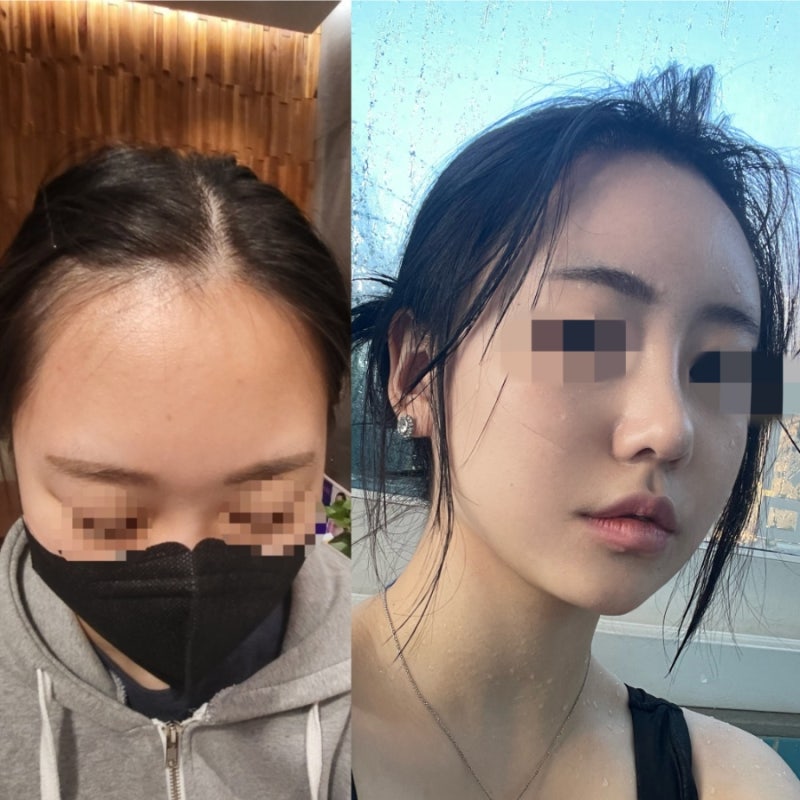 강남 이마필러미간and턱 보톡스 전후 효과 부작용 리터치 후기 추천 주의사항 네이버 블로그
