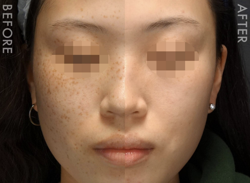 피코토닝 Vs 레이저토닝 비교 효과 부작용 가격 시술 간격 통증 문신 제거 총정리 네이버 블로그