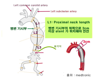 TEVAR & EVAR (하이브리드 수술) : 네이버 블로그