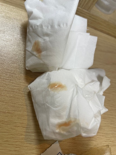 표피낭종피지낭종 제거 후기 4 핀홀법 수술 실패 부작용 재수술 네이버 블로그