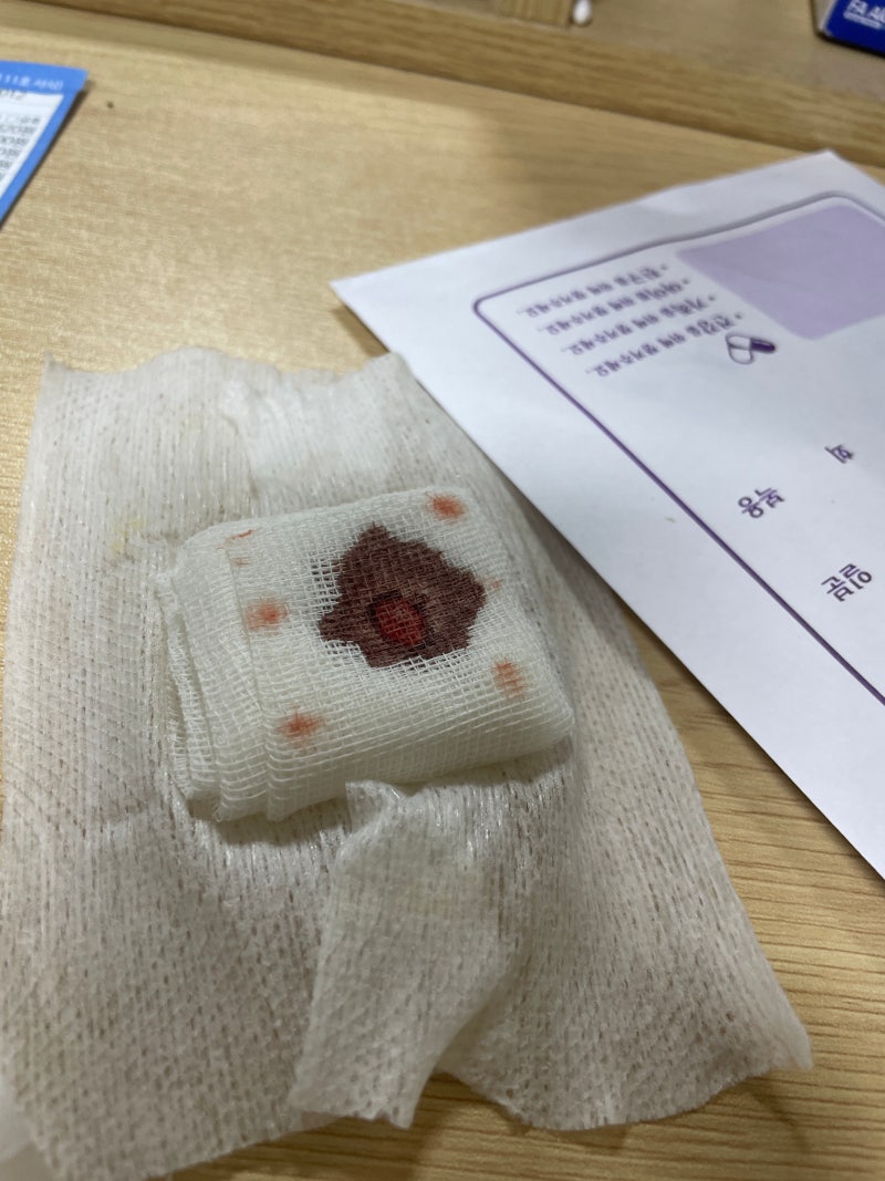 표피낭종피지낭종 제거 후기 4 핀홀법 수술 실패 부작용 재수술 네이버 블로그