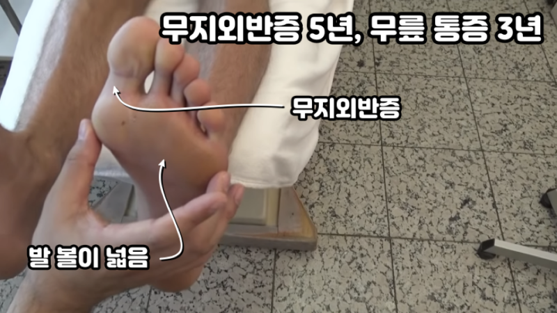 131. 무릎 관절염, 무지 외반증 KSNS KSS 스본 스도 공부 자료 : 네이버 블로그