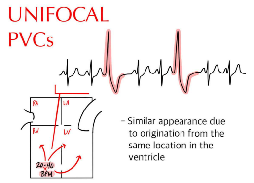 EKG : Ventricular rhythm 기초, TdP(Torsades de pointes) : 네이버 블로그
