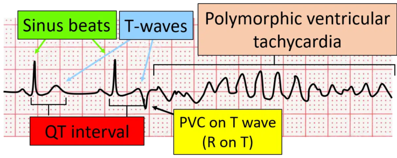 EKG : Ventricular rhythm 기초, TdP(Torsades de pointes) : 네이버 블로그