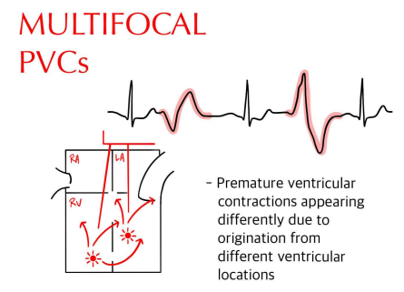 EKG : Ventricular rhythm 기초, TdP(Torsades de pointes) : 네이버 블로그