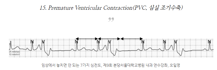 EKG : Ventricular rhythm 기초, TdP(Torsades de pointes) : 네이버 블로그