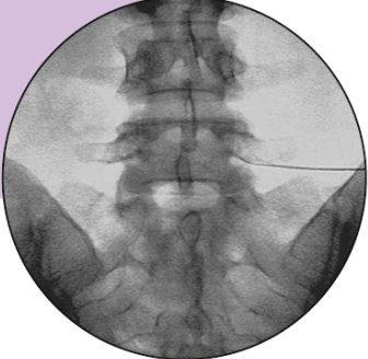 경추간공 경막외 스테로이드 주사(TransForaminal Epidural Steroid Injection, TFESI ...