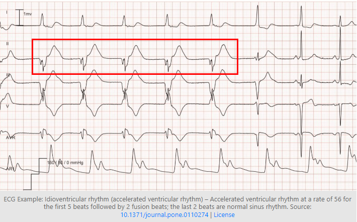 EKG : Ventricular rhythm 기초, TdP(Torsades de pointes) : 네이버 블로그