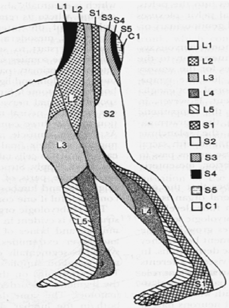 경추간공 경막외 스테로이드 주사(TransForaminal Epidural Steroid Injection, TFESI ...