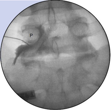 경추간공 경막외 스테로이드 주사(TransForaminal Epidural Steroid Injection, TFESI ...