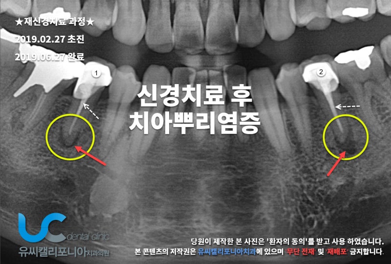 신경치료 후 통증 발생 재신경치료 비용 후기 다양한 증례 모음zip 네이버 블로그