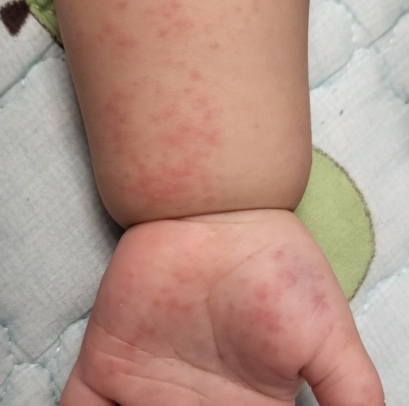 아기 수족구 증상 유아 어린이 구내염 아구창 차이는 네이버 블로그