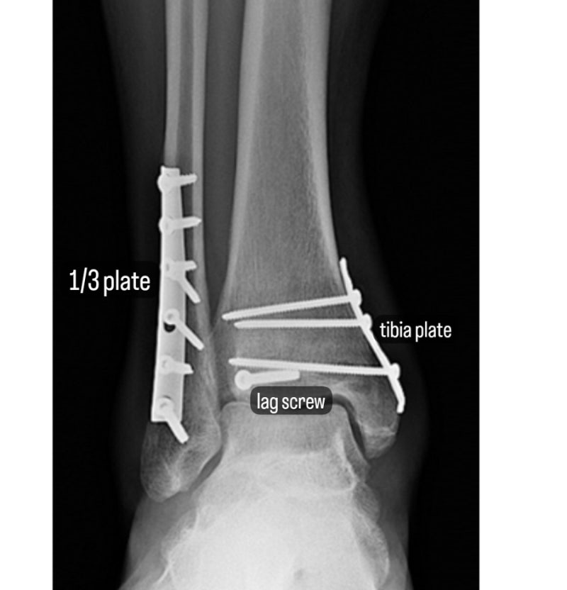 정형외과스크럽 ORIF ankle fx op(bimalleolar fx. trimalleolar fx) : 네이버 블로그