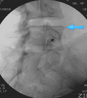경추간공 경막외 스테로이드 주사(TransForaminal Epidural Steroid Injection, TFESI ...