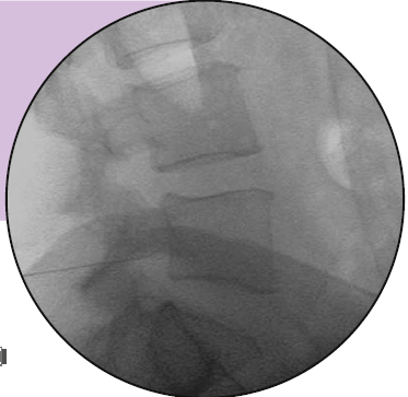 경추간공 경막외 스테로이드 주사(TransForaminal Epidural Steroid Injection, TFESI ...